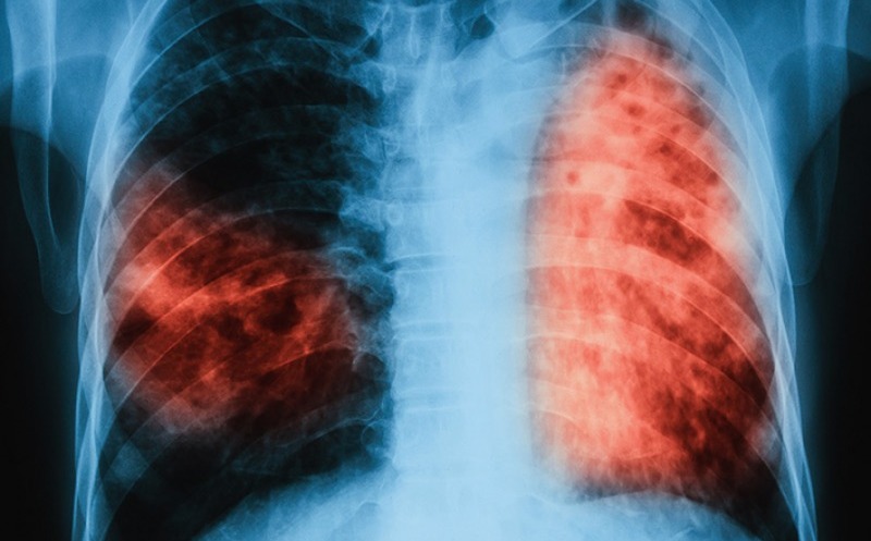Tuberculosis multirresistente: una amenaza mortal creciente- Grupo Milenio