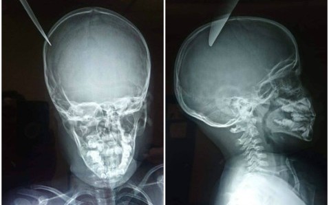 En Sonora, niño clava cuchillo en la cabeza a otro- Grupo Milenio