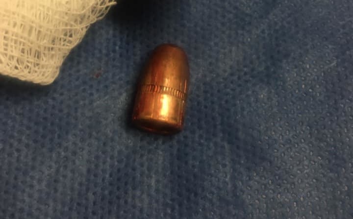 En festejos de Año Nuevo, bala perdida impacta en dedo de una mujer ...