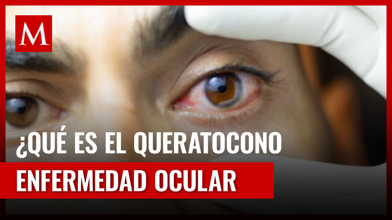 Visión borrosa en adolescentes: Causas y tratamientos del Queratocono ...