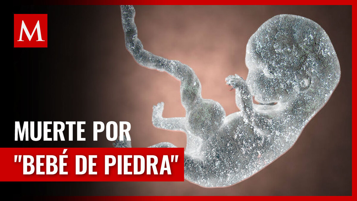 Anciana brasileña muere con feto calcificado- Grupo Milenio